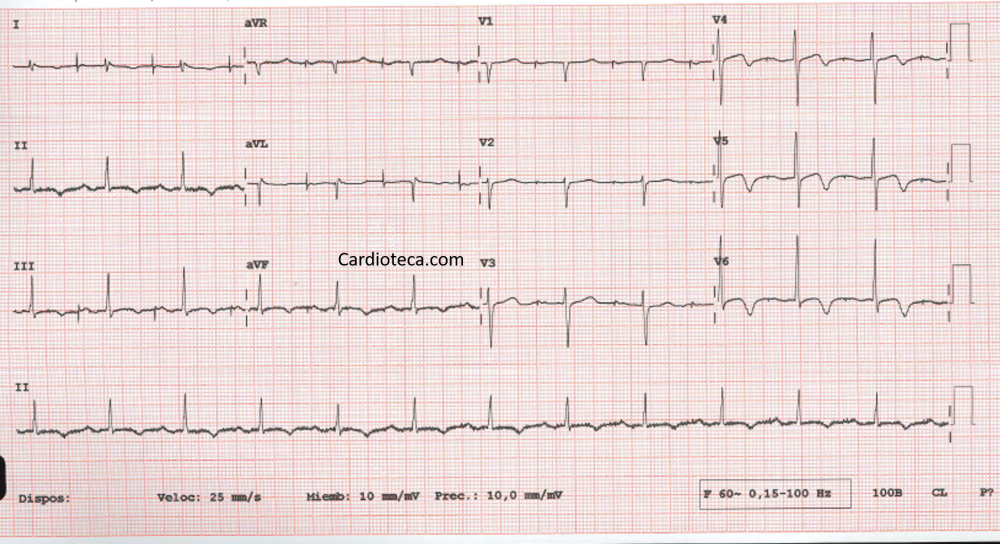 Curso ECG: Resincronizador que tras la descarga pasa a estimular sin ...