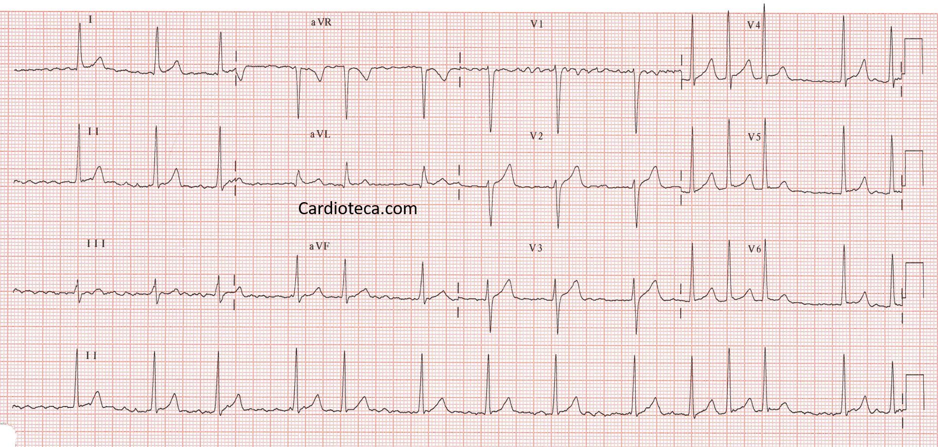 Curso ECG Fibrilaci n Auricular