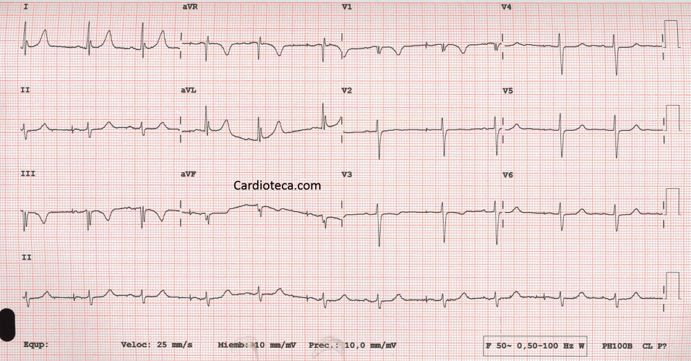 Curso ECG: Marcapasos AAI