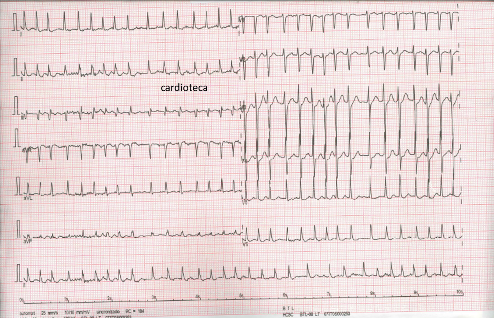 Curso ECG Fibrilaci n Auricular IV 
