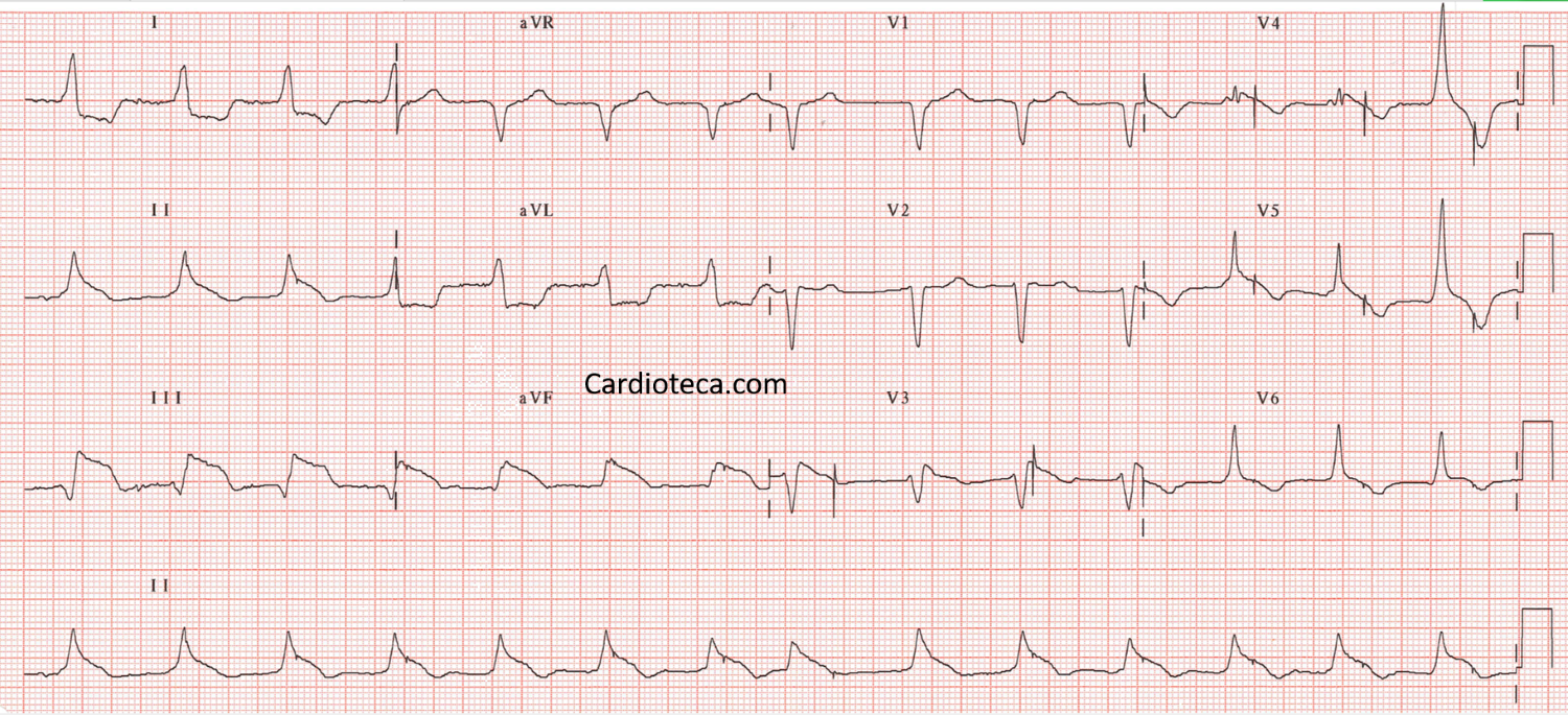 Curso ECG: Infarto agudo de miocardio de cara inferior y marcapasos con ...