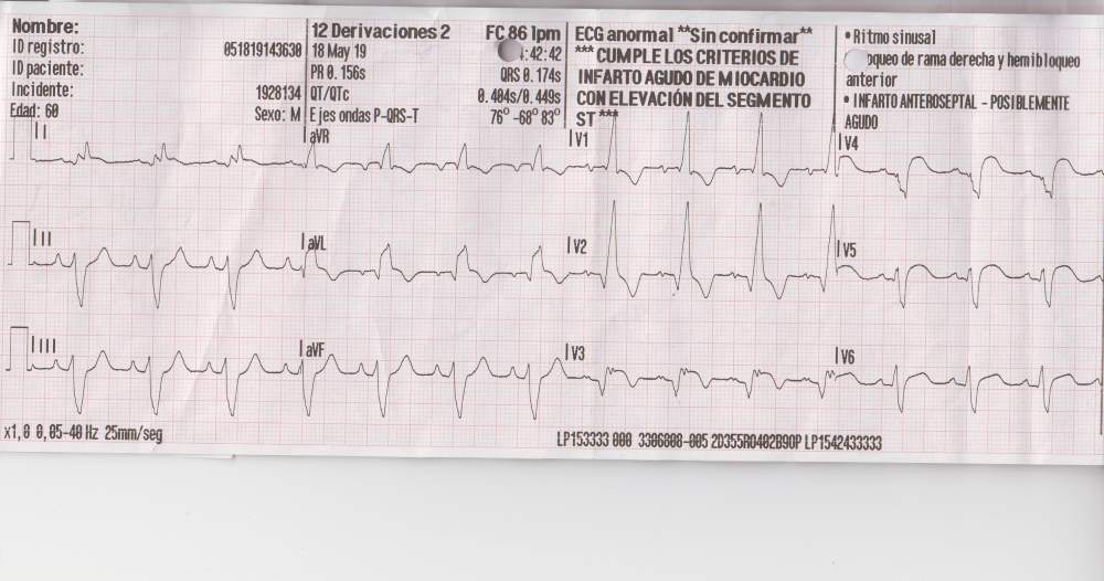 Curso ECG: Infarto anterior agudo (I)